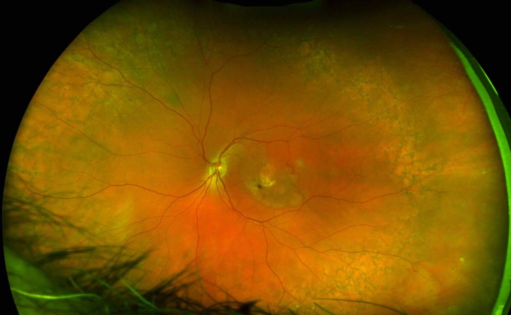 AMD-Wet-California-Courtesy-Tim-Steffens-CRA-OCT-C-FOPS