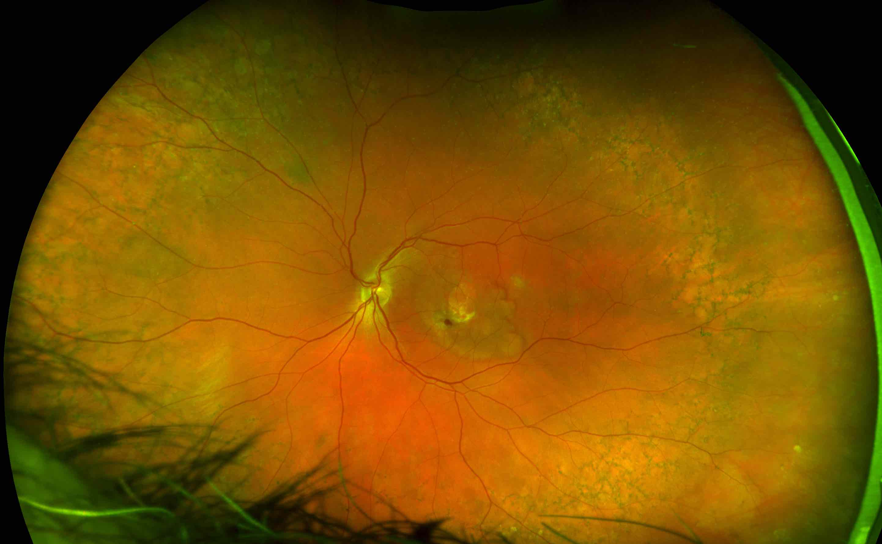 Retinal Imaging